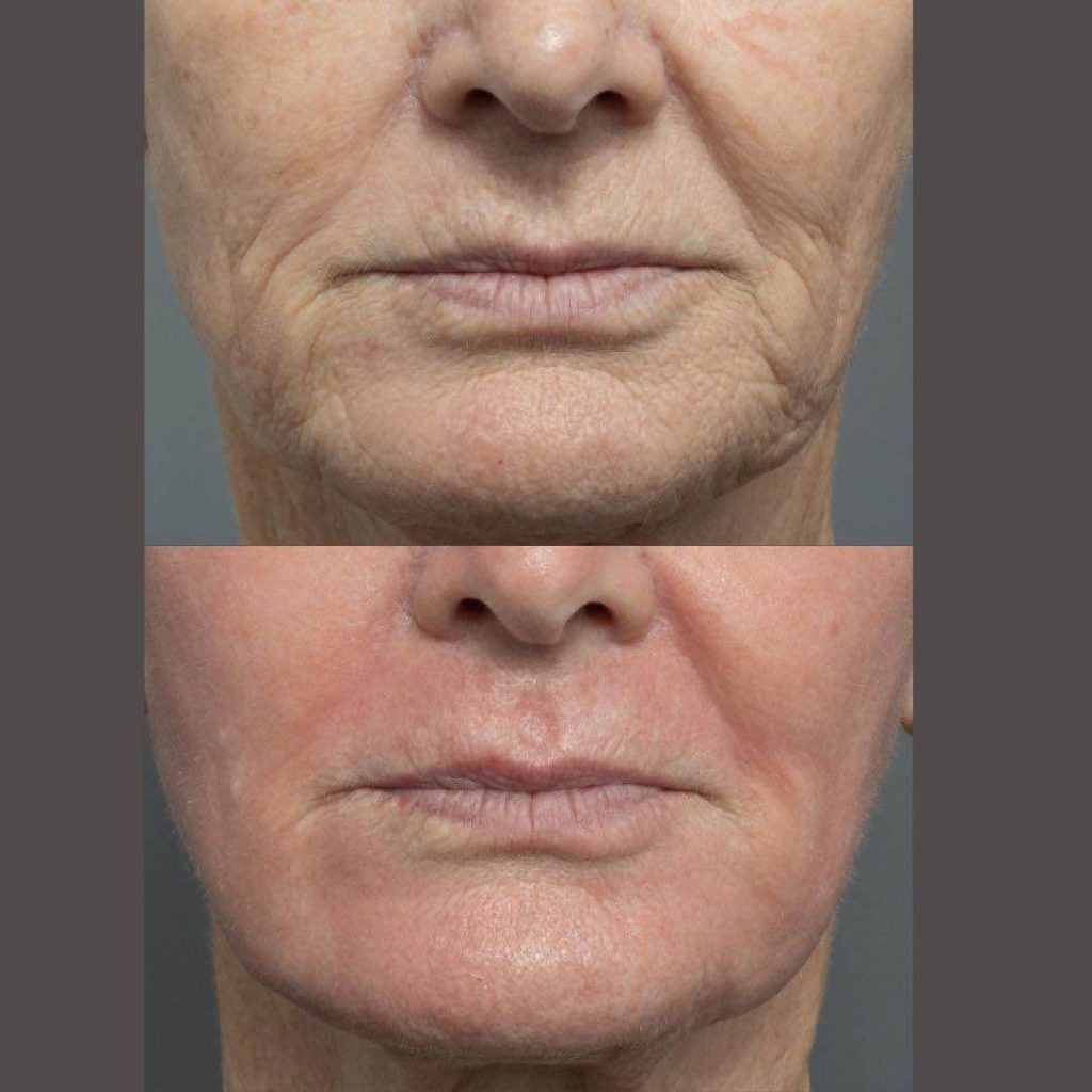 Perioral/Lip Rejuvenation Gallery - Dr Davin Lim