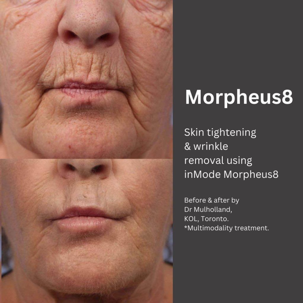 Perioral/Lip Rejuvenation Gallery - Dr Davin Lim