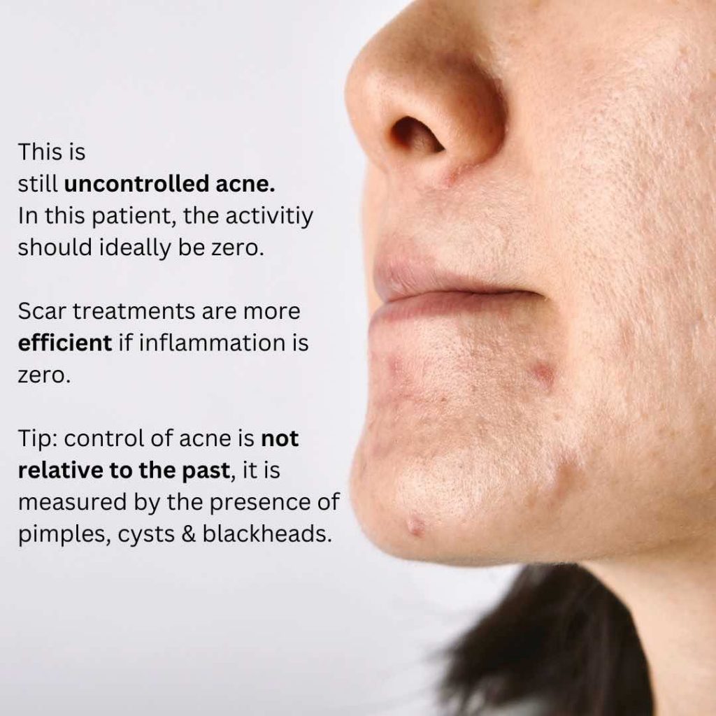 Can't Stop Picking Acne? Best Solutions - Dr Davin Lim