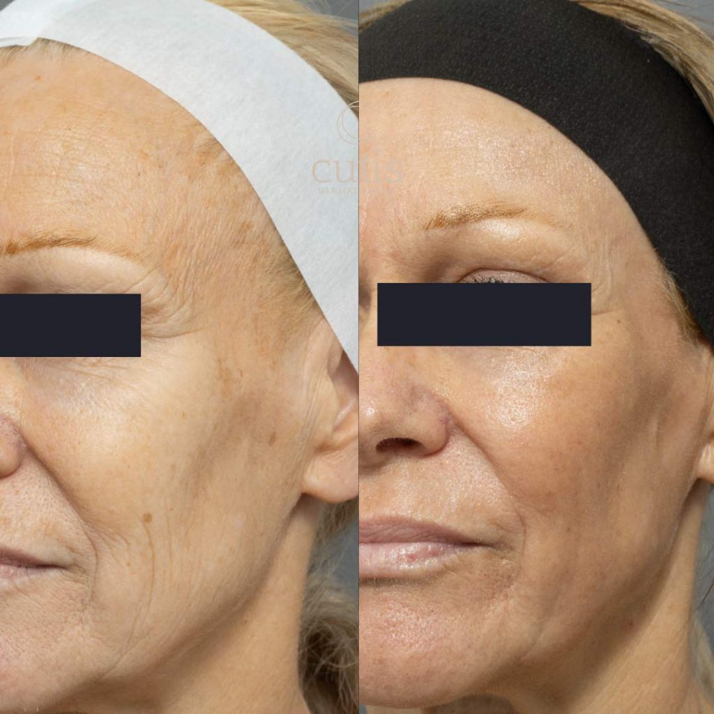 Laser Resurfacing Gallery - Dr Davin Lim