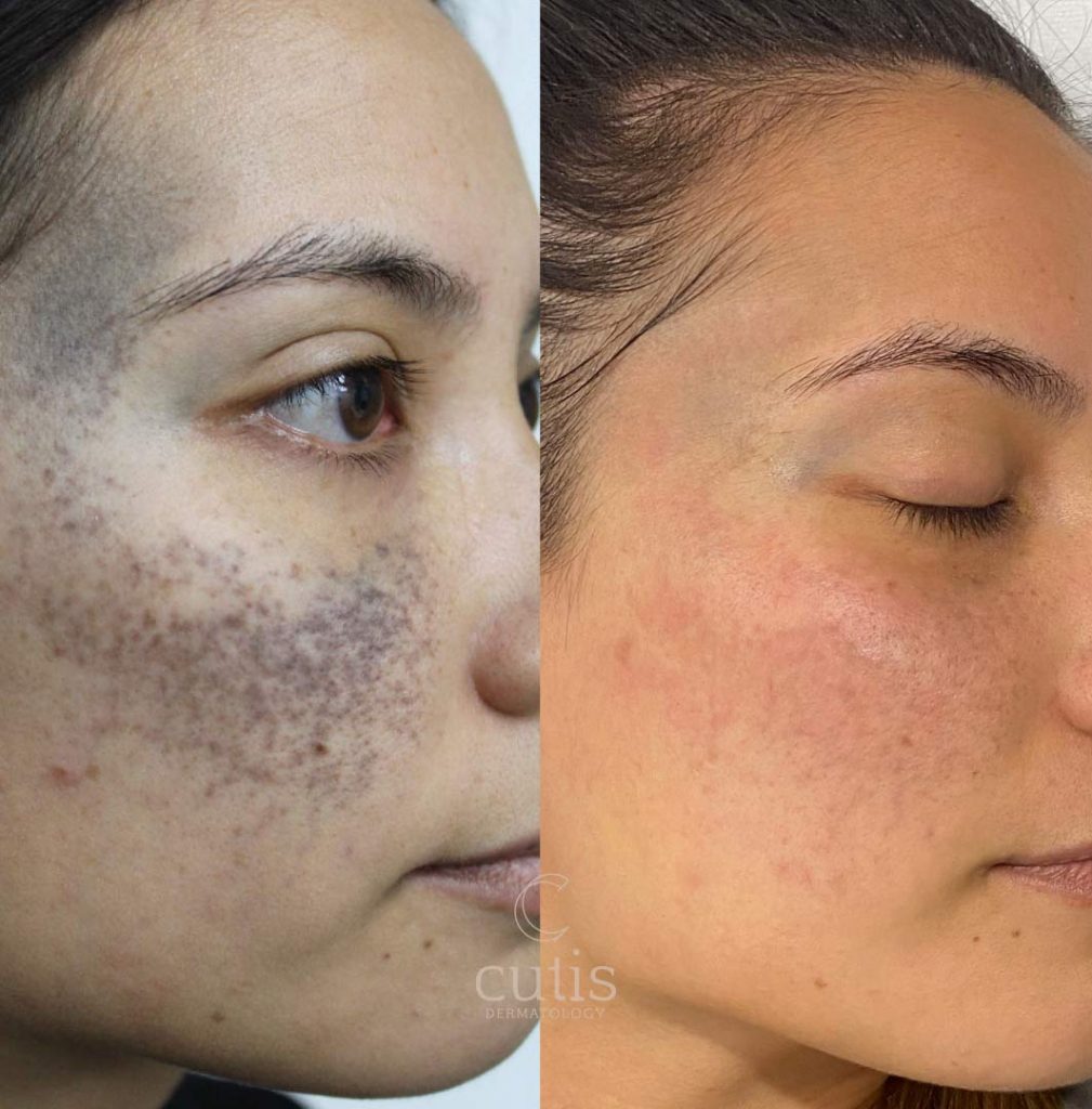 Pigmentation Gallery - Dr Davin Lim