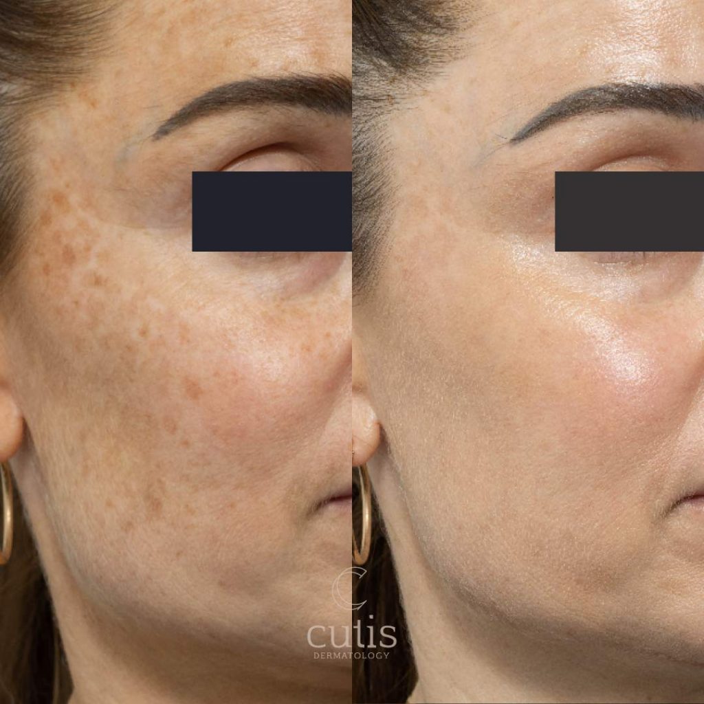 Pigmentation Gallery - Dr Davin Lim