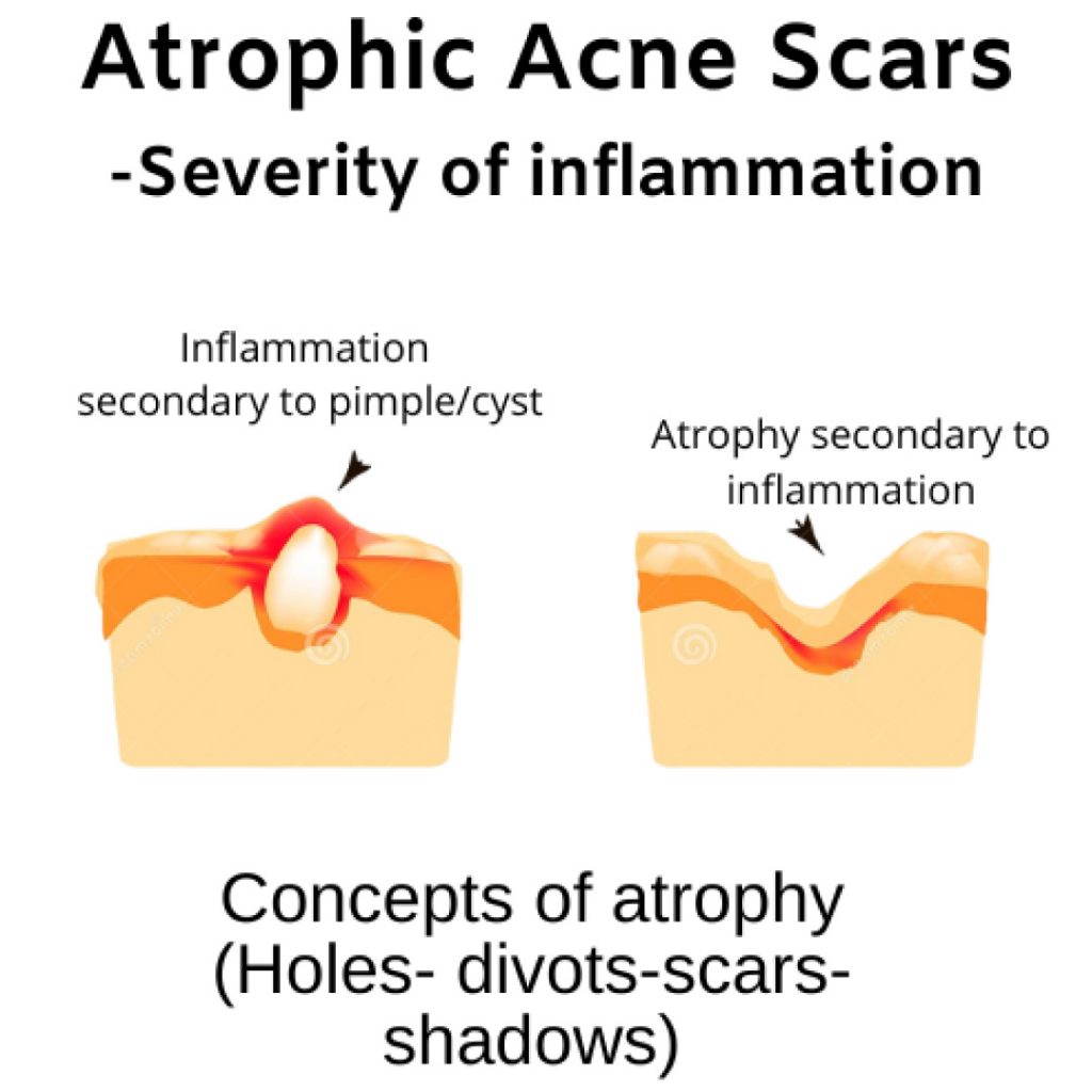 The Acne Scar Repair Series Brisbane - Dr Davin Lim