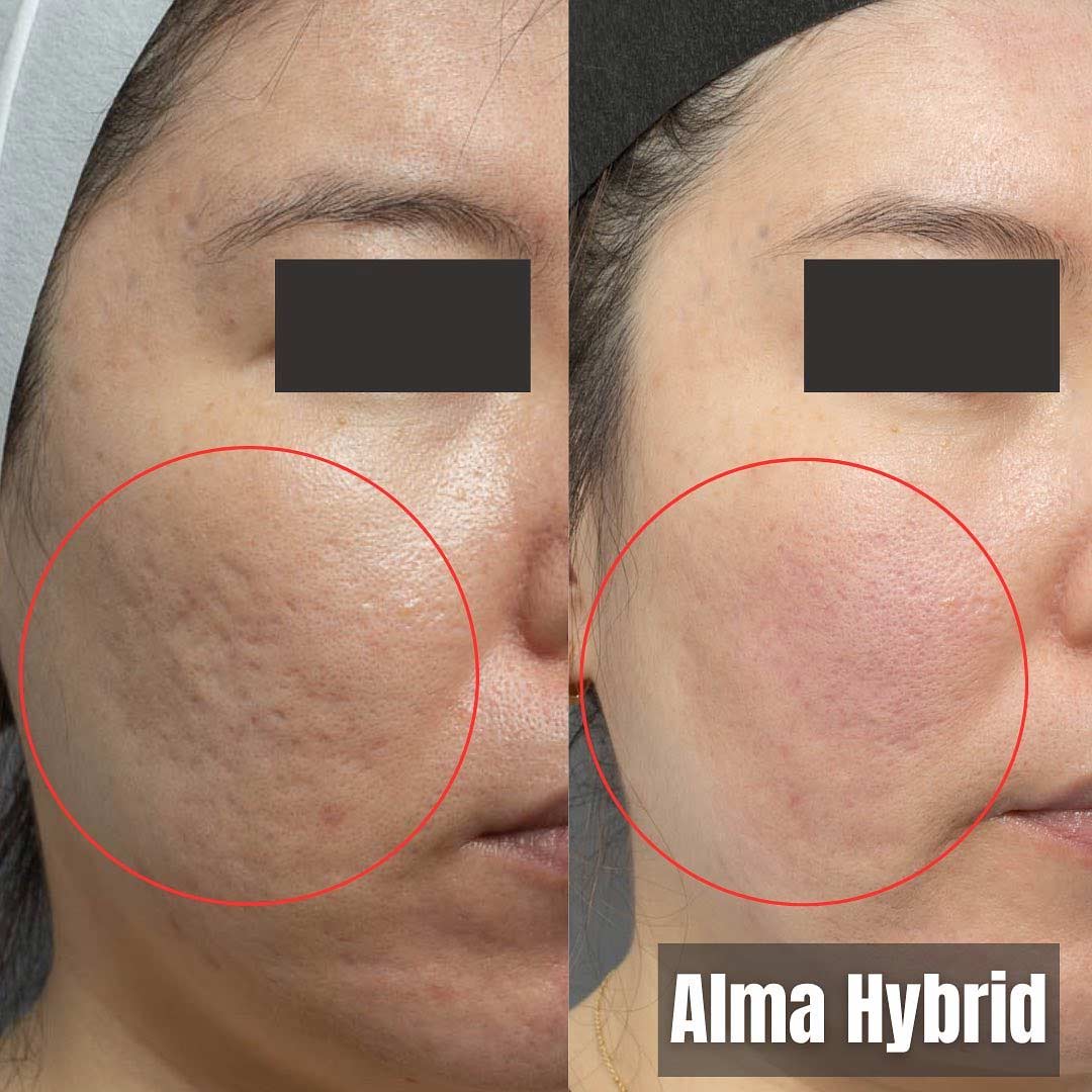 The Acne Scar Repair Series Brisbane - Dr Davin Lim