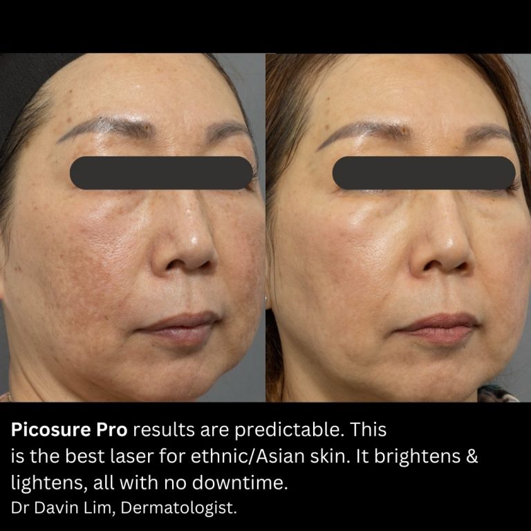 Pigmentation Treatment With The Picosure Laser | Dr Davin Lim