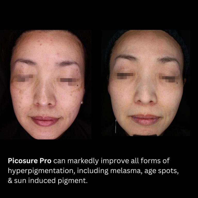 Pigmentation Treatment With The Picosure Laser | Dr Davin Lim
