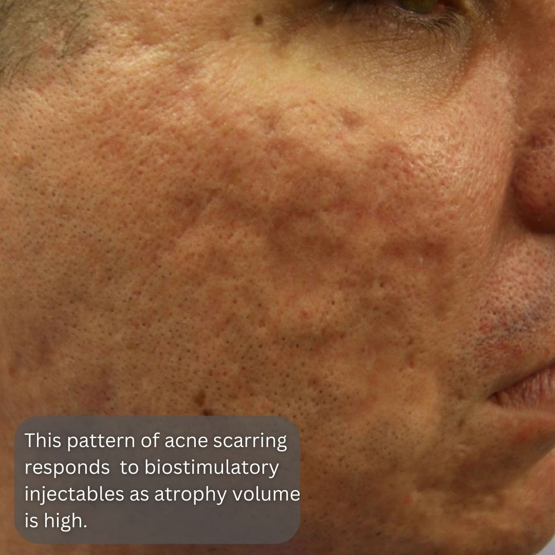 Bioremodulator Injections For Acne Scars In Brisbane | Dr Davin Lim