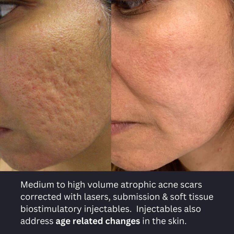 Bioremodulator Injections For Acne Scars In Brisbane | Dr Davin Lim