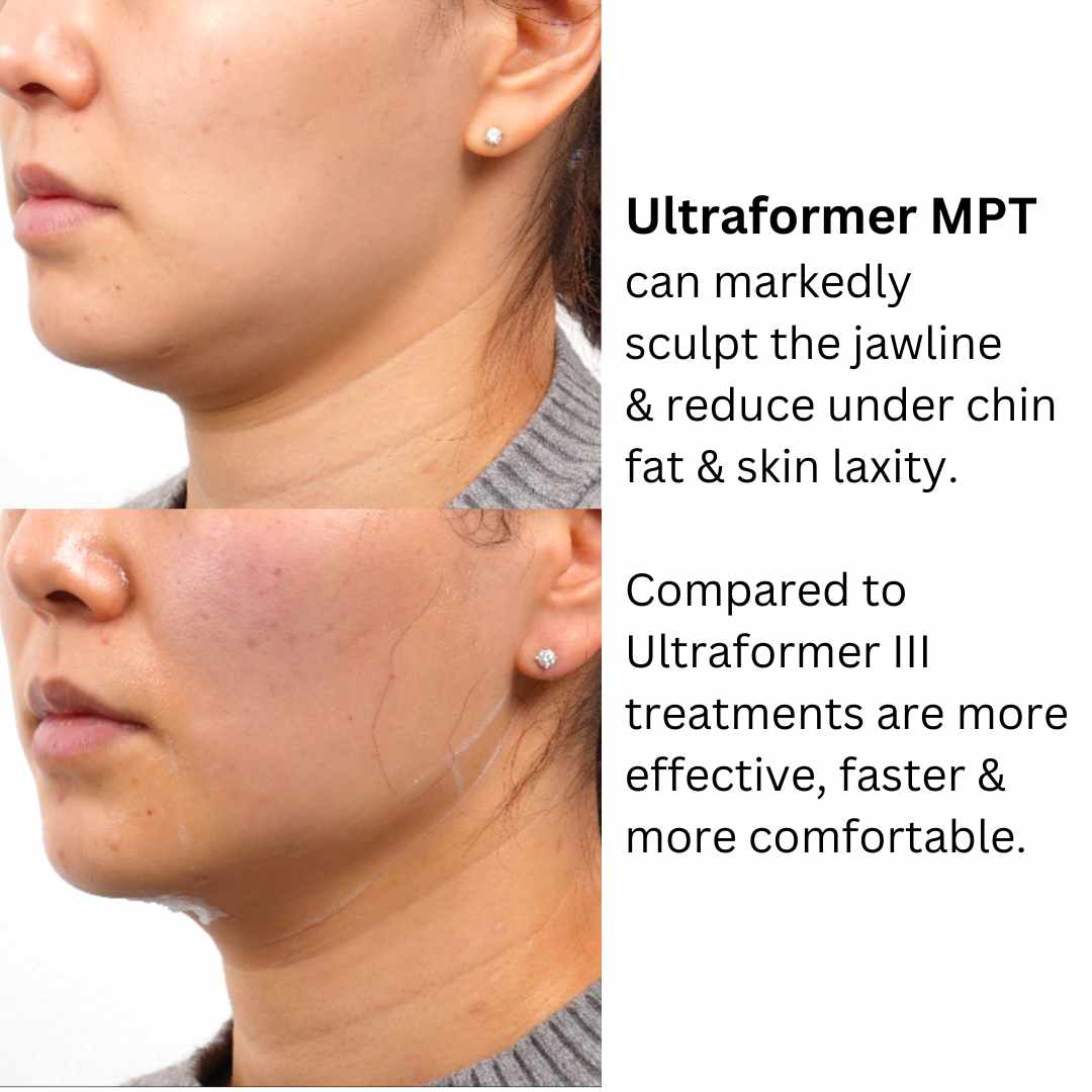 Ultraformer MPT: Unparalleled 2025 Skin Tightening Australia - Dr Davin Lim