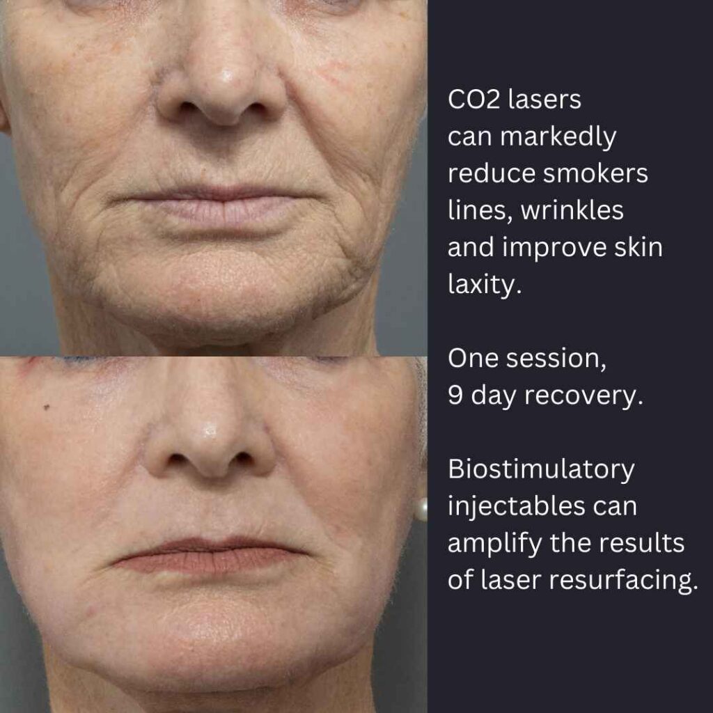 Pixel Laser Recovery