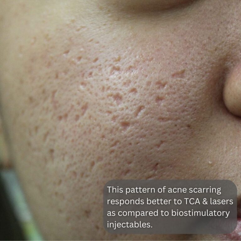 Bioremodulator Injections For Acne Scars In Brisbane | Dr Davin Lim