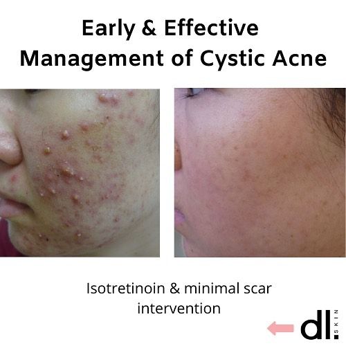 Acne Cyst Scar